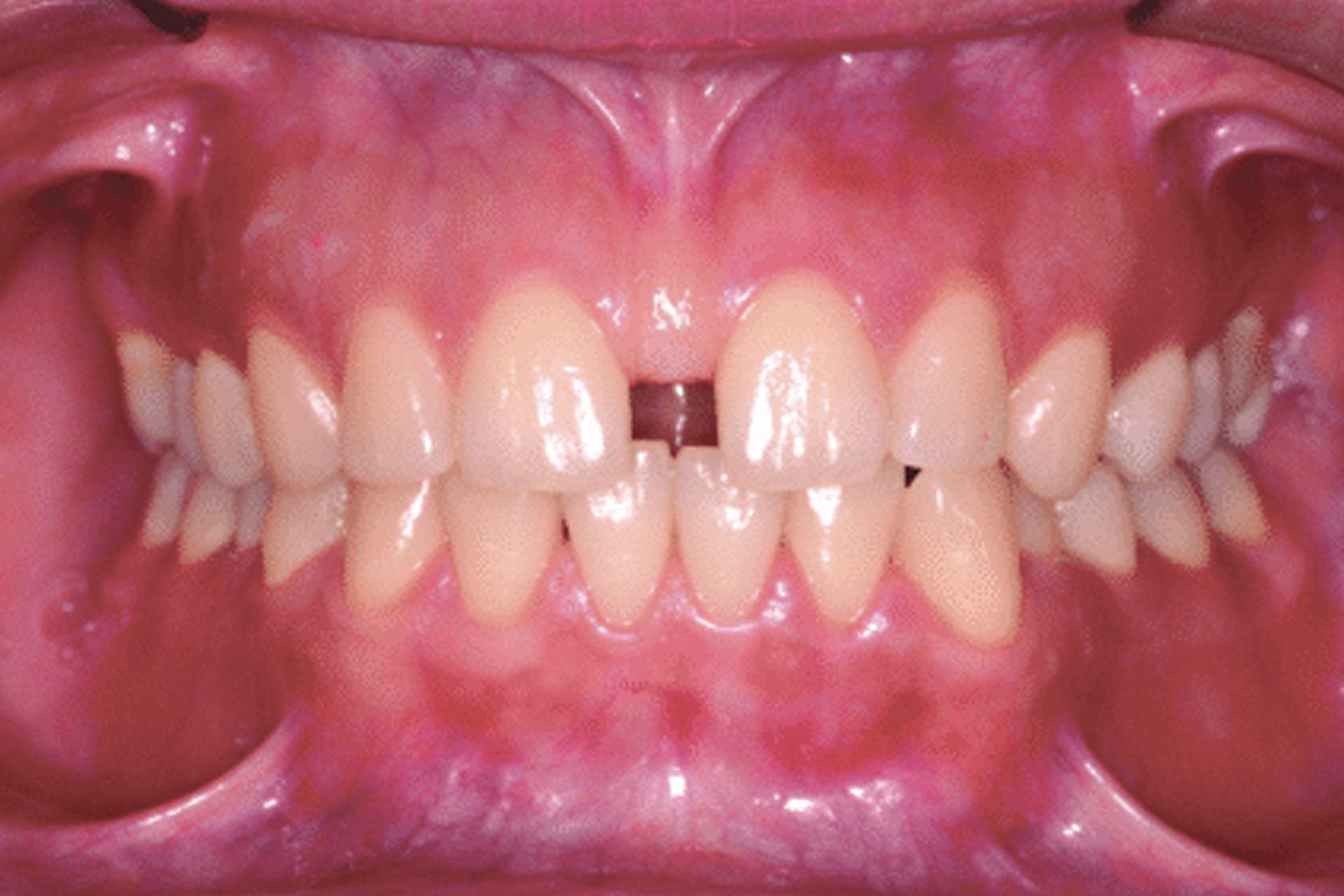 Diastema Causes and Treatment Options - Orthodontics in Singapore