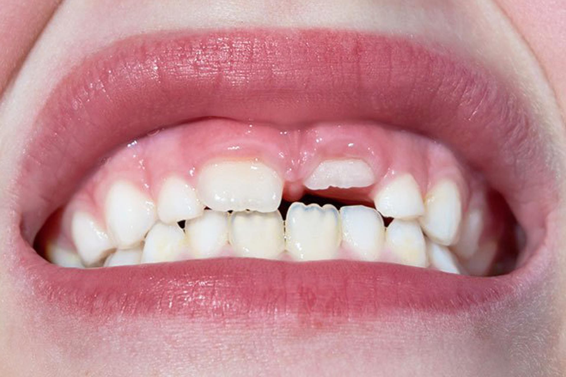 Diastema Causes and Treatment Options - Orthodontics in Singapore