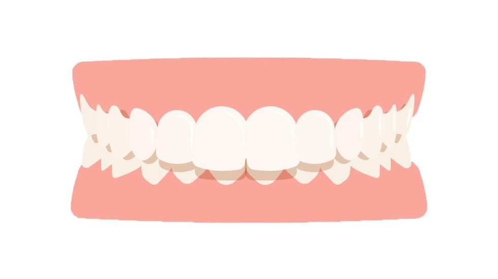 What is an overbite? How do I fix an overbite?