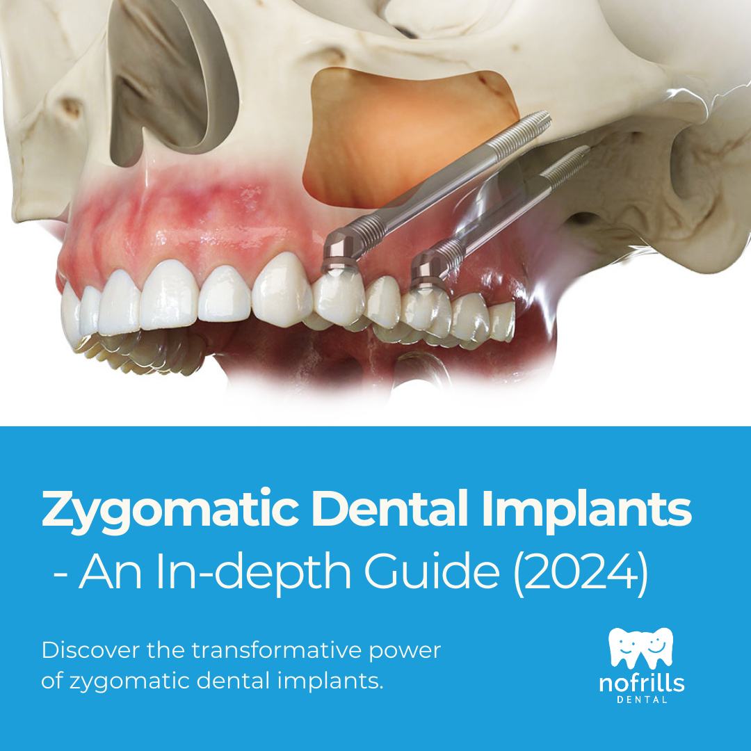 Zygomatic Implants The Anatomy Guided Approach Product Review: